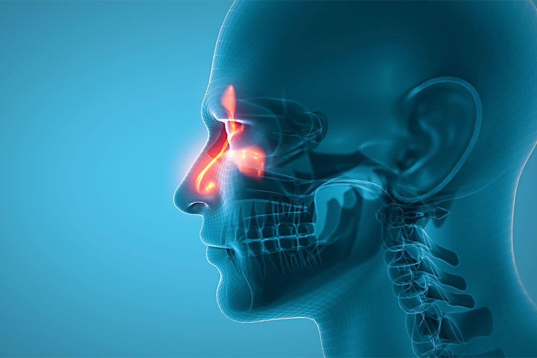 Rinosinusite cronica con poliposi nasale (CRSwNP): percorso integrato ...
